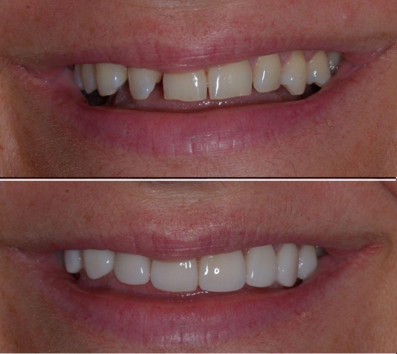 upper lower case 2 | Surrey Dental Spa